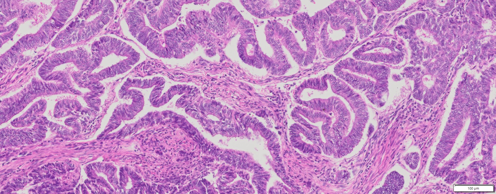 Human endometrioid (Adenocarcinoma of the endometrium) FFPE Sections