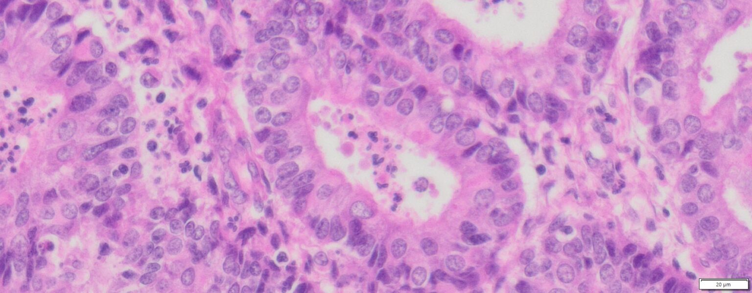 Human Endometroid (Adenocarcinoma) FFPE Sections