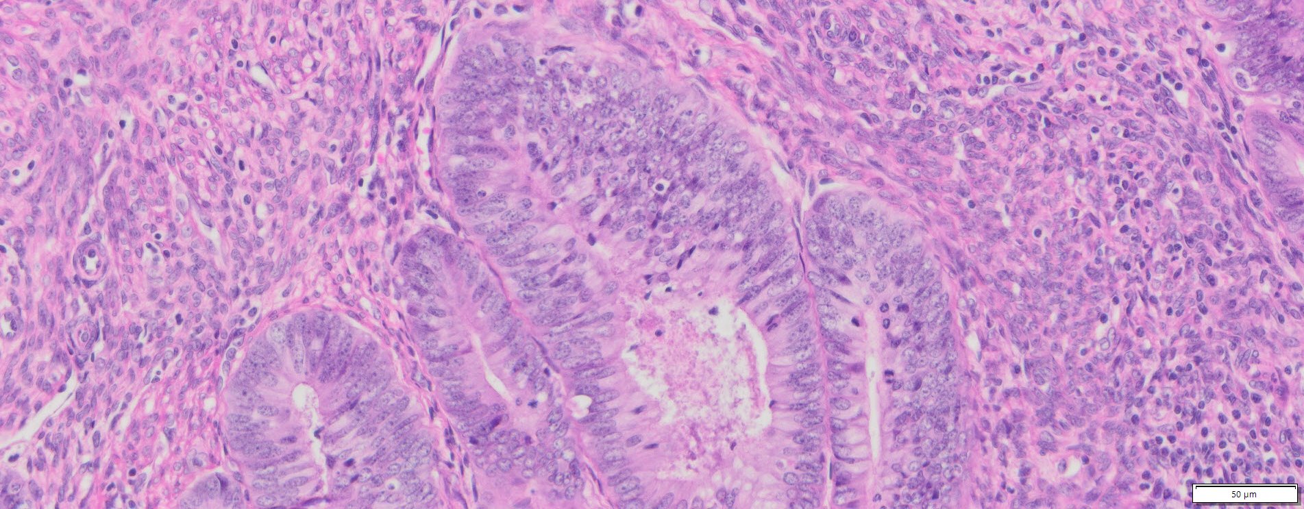 Human Endometroid (Adenocarcinoma) FFPE Sections