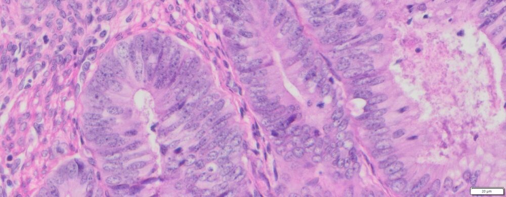 Human Endometroid (Adenocarcinoma) FFPE Sections