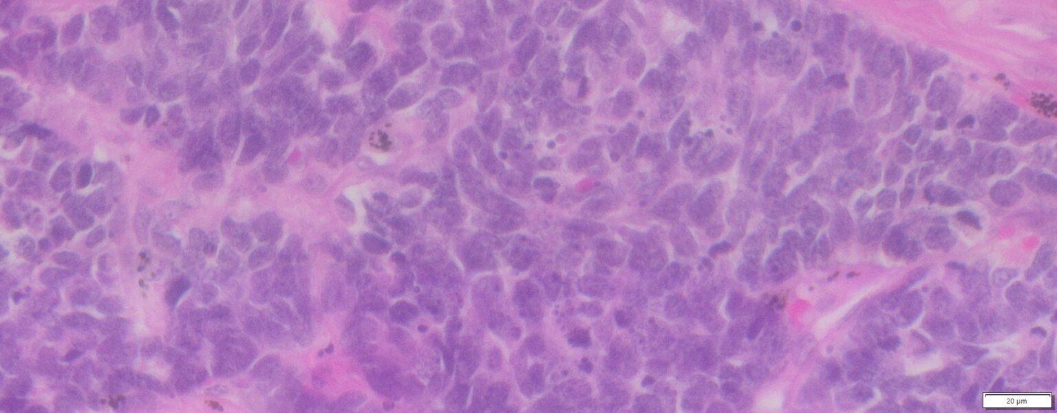 Human Small Cell Lung Cancer FFPE Sections