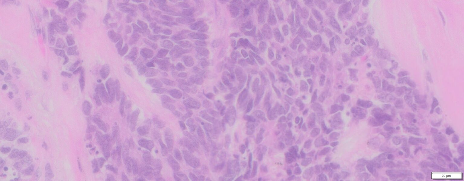 Human Small Cell Lung Cancer FFPE Sections