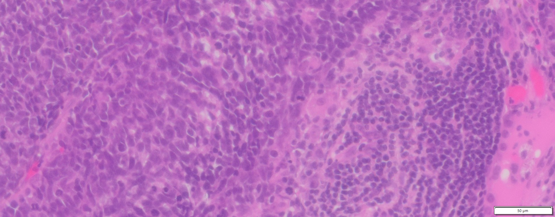 Human Small Cell Lung Cancer FFPE Sections
