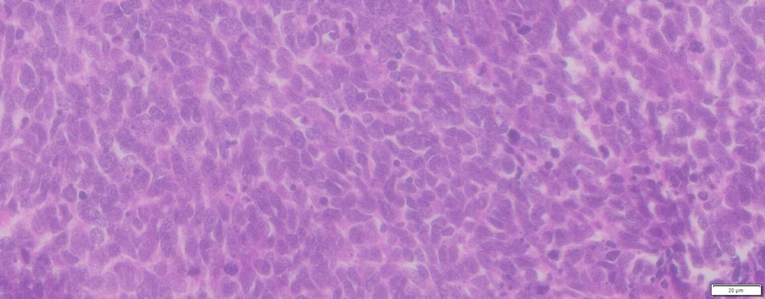 Human Small Cell Lung Cancer FFPE Sections