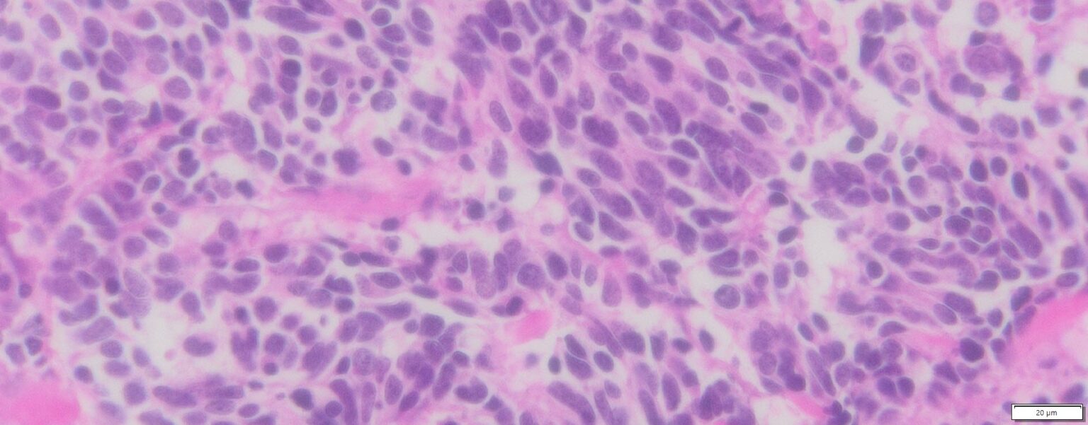 Human Small Cell Lung Cancer FFPE Sections