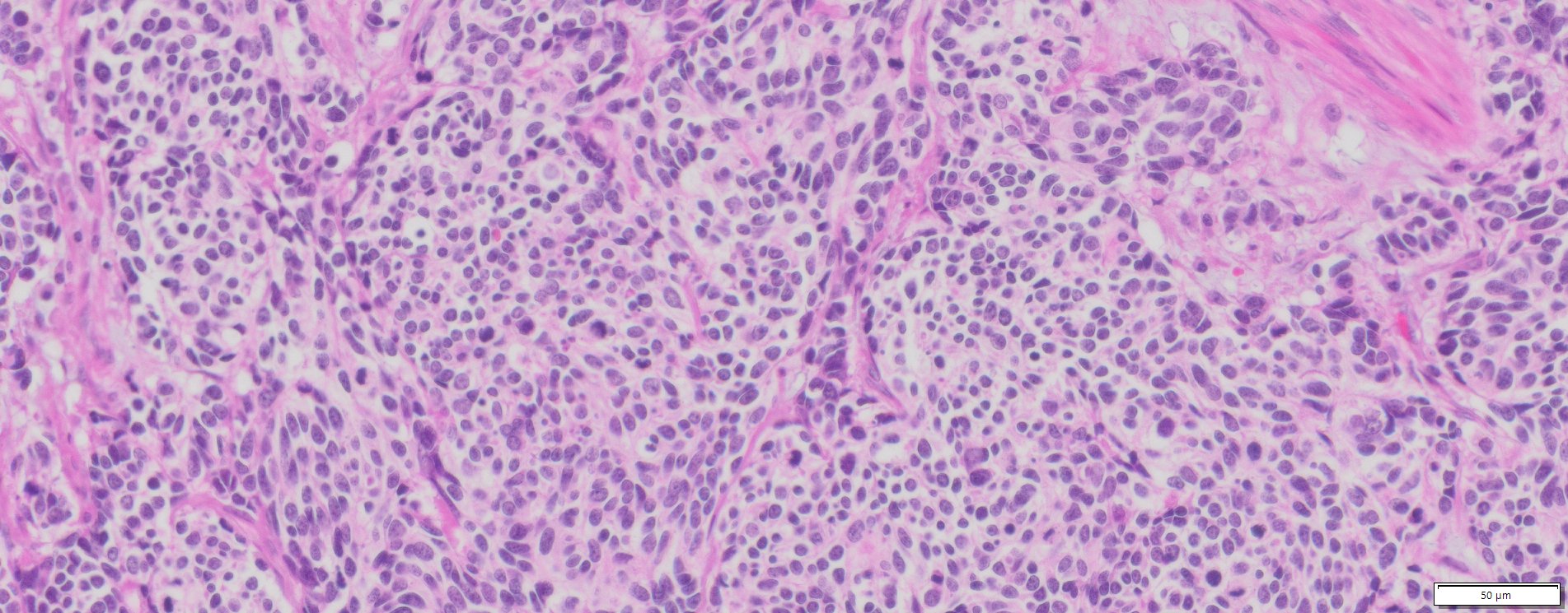Human Small Cell Lung Cancer FFPE Sections