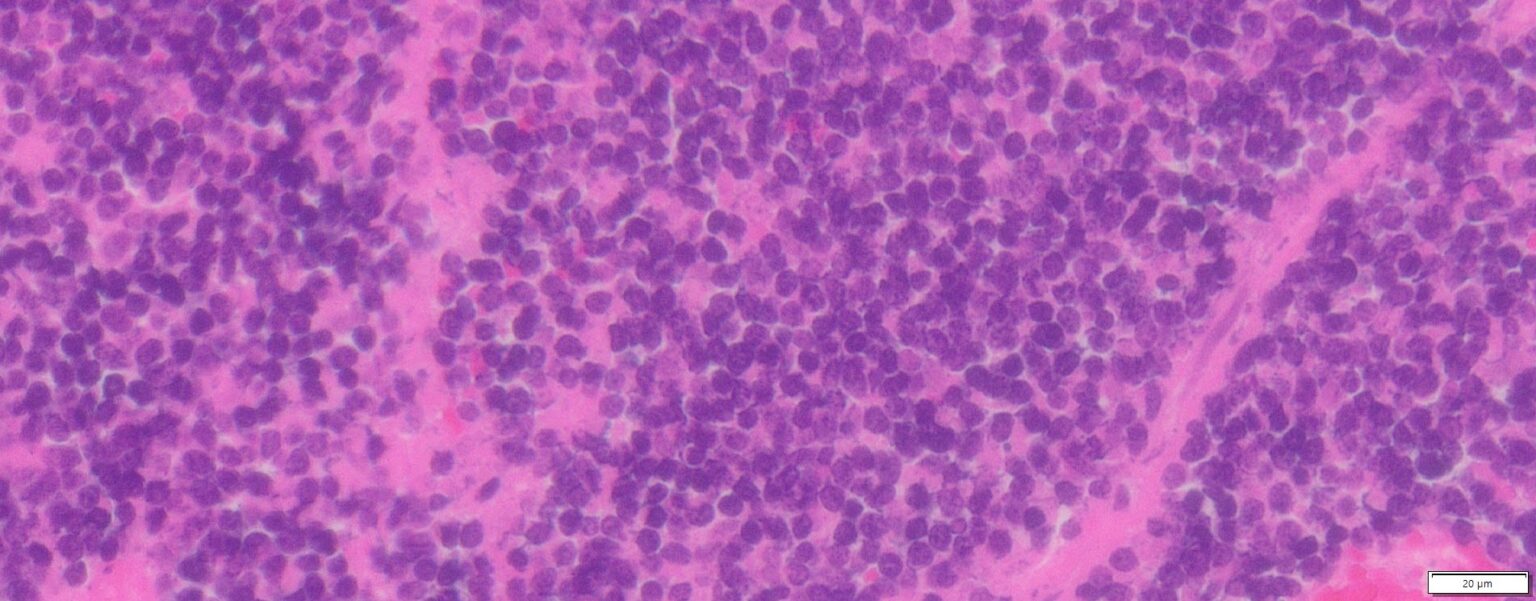 Human Small Cell Lung Cancer FFPE Sections