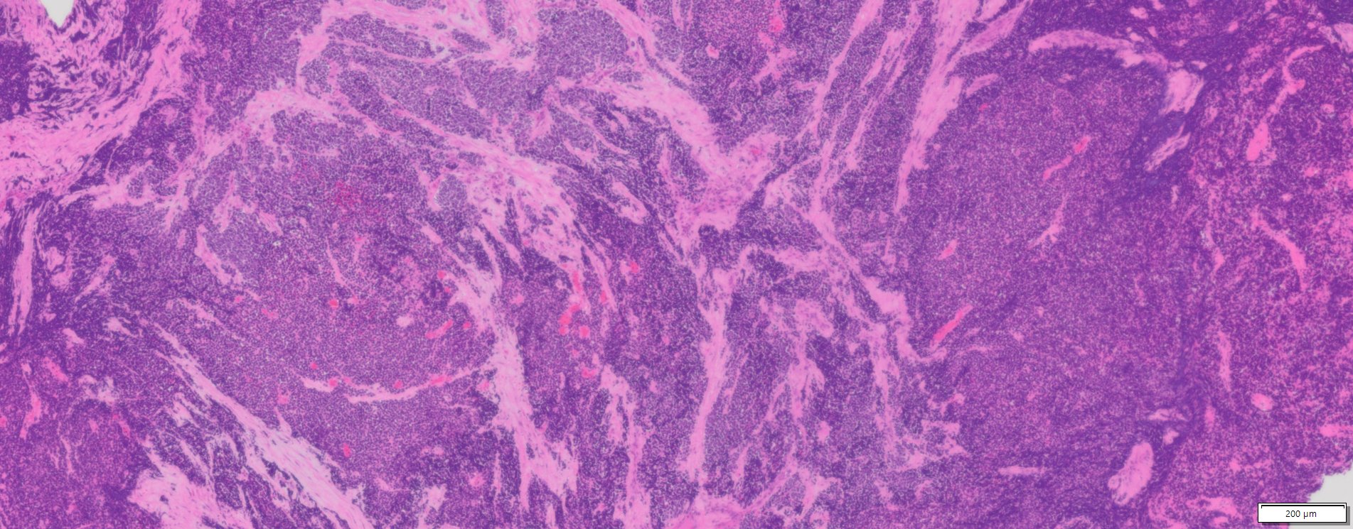 Human Small Cell Lung Cancer FFPE Sections