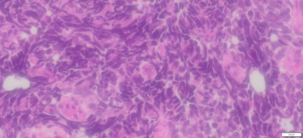 Human Small Cell Lung Cancer FFPE Sections