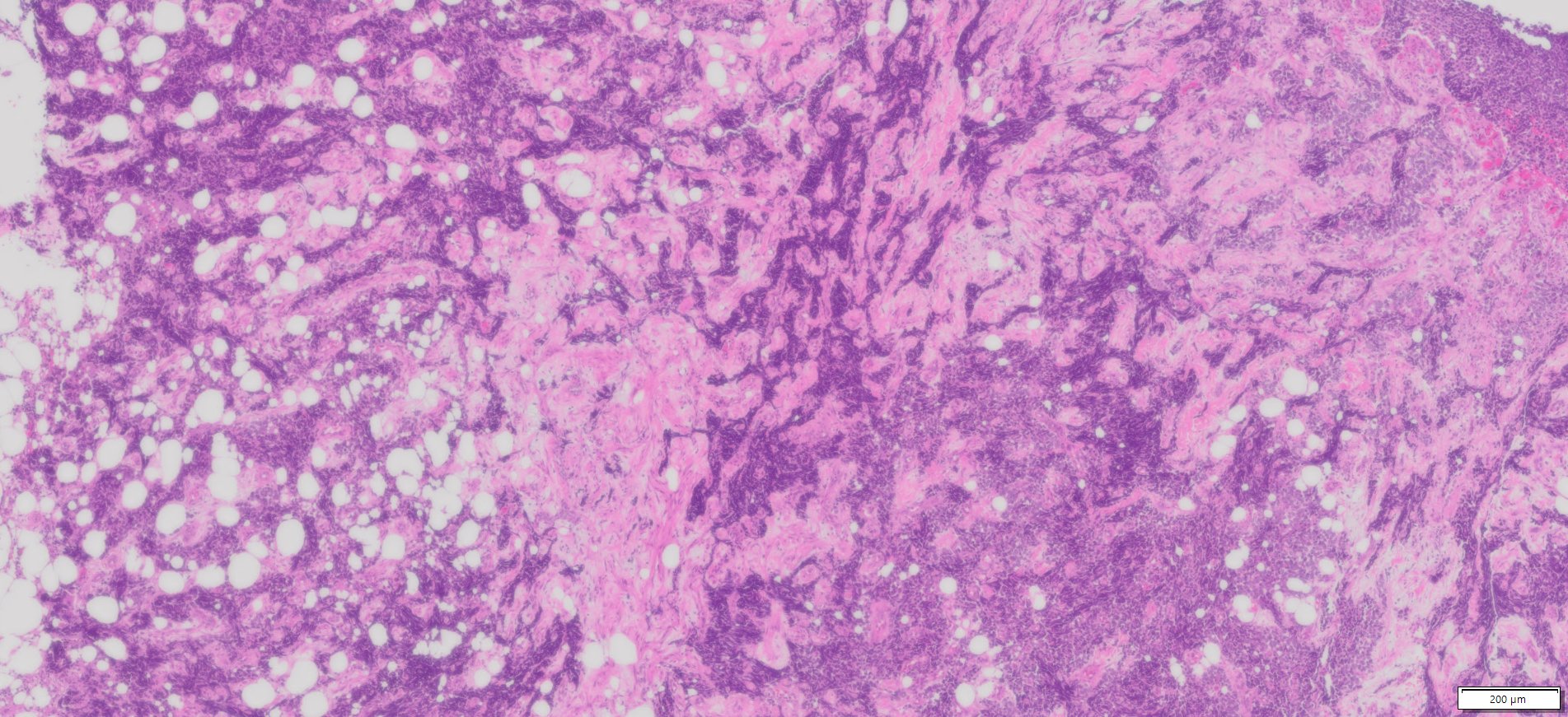 Human Small Cell Lung Cancer FFPE Sections