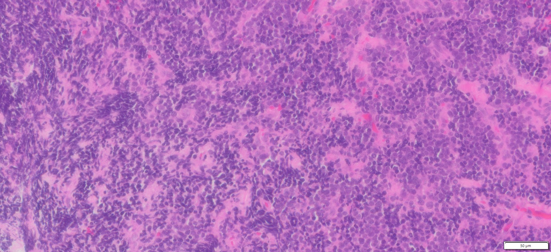 Human Small Cell Lung Cancer FFPE Sections