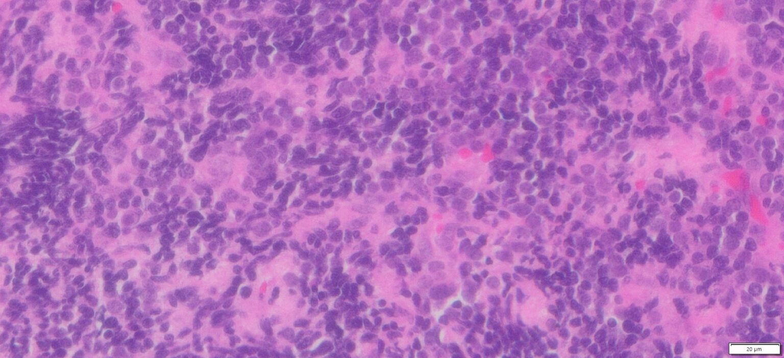 Human Small Cell Lung Cancer FFPE Sections