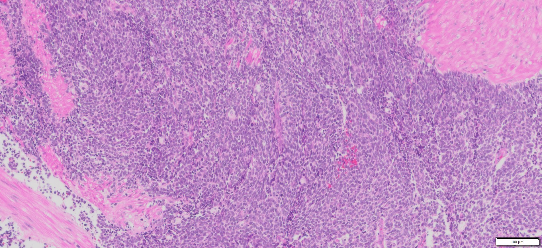 Human Small Cell Lung Cancer FFPE Sections