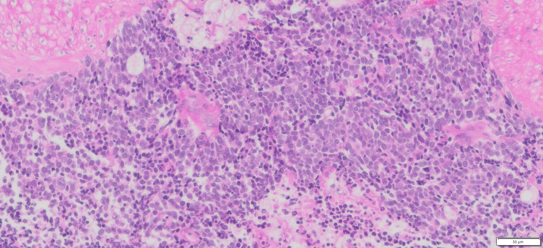 Human Small Cell Lung Cancer FFPE Sections