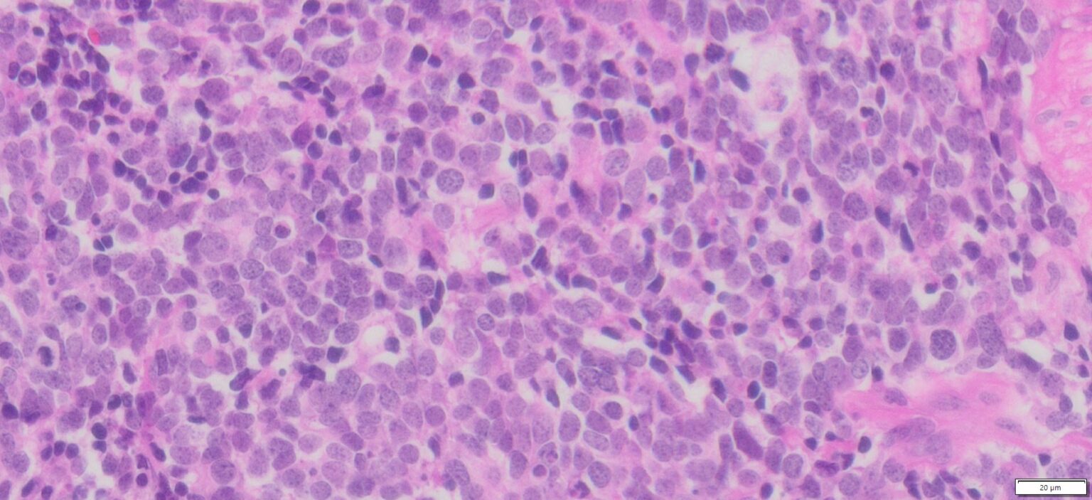 Human Small Cell Lung Cancer FFPE Sections