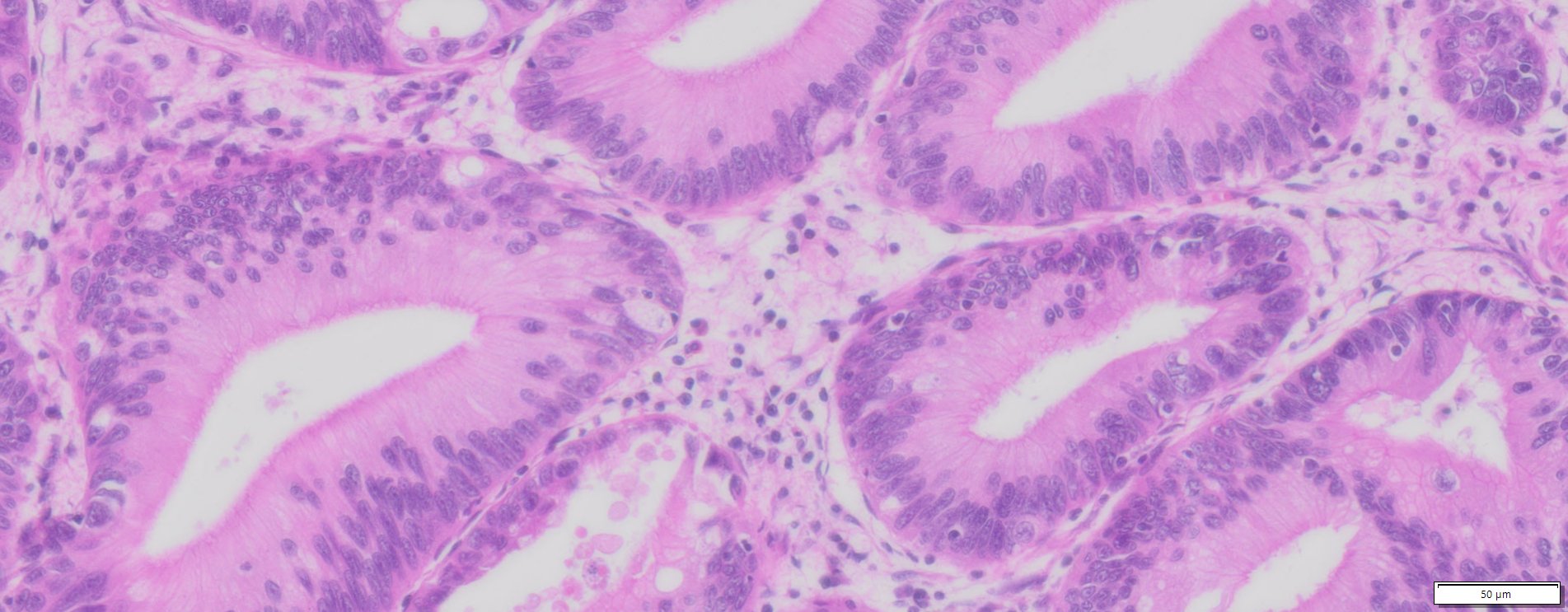 Human Pancreas Cancer (Adenocarcinoma) FFPE Sections