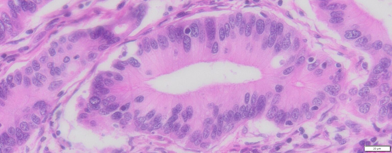 Human Pancreas Cancer (Adenocarcinoma) FFPE Sections