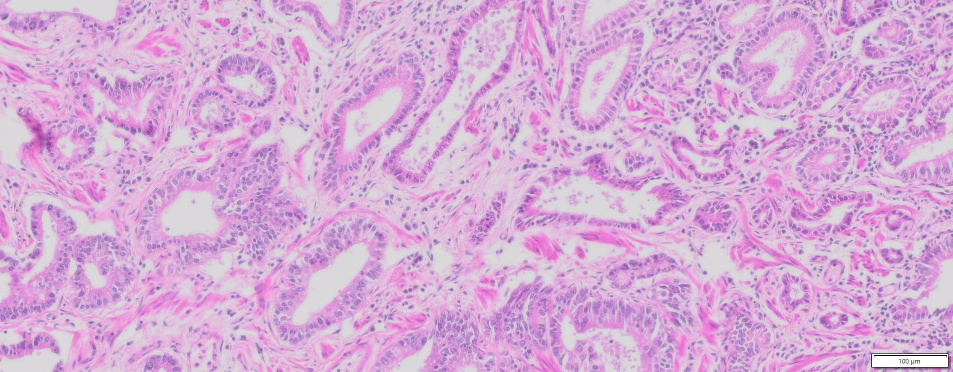 Human Pancreas Cancer (Adenocarcinoma) FFPE Sections