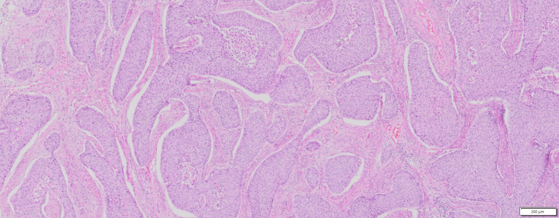 Human Pancreas Cancer (Neuroendocrine Tumor) FFPE Sections