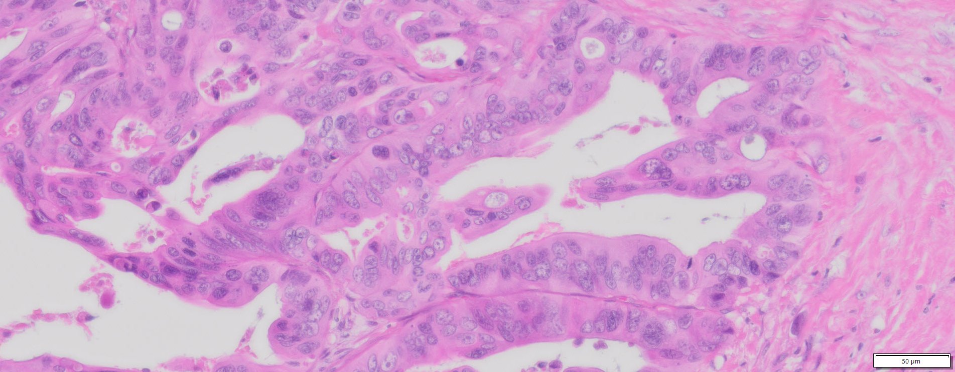 Human Pancreas Cancer (Adenocarcinoma) FFPE Sections