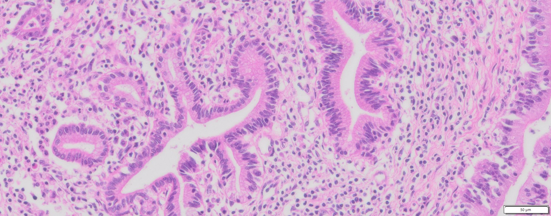 Human Pancreas Cancer (Adenocarcinoma) FFPE Sections