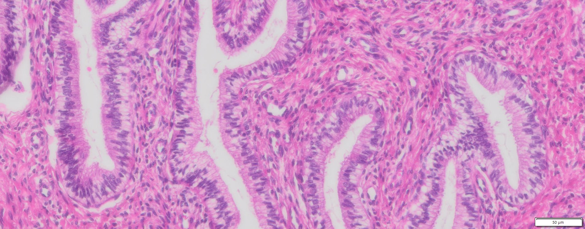 Human Pancreas Cancer (Adenocarcinoma) FFPE Sections