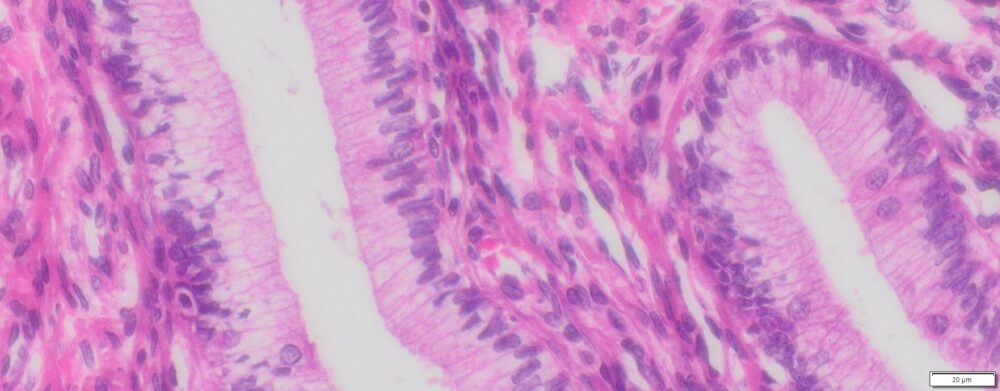 Human Pancreas Cancer (Adenocarcinoma) FFPE Sections