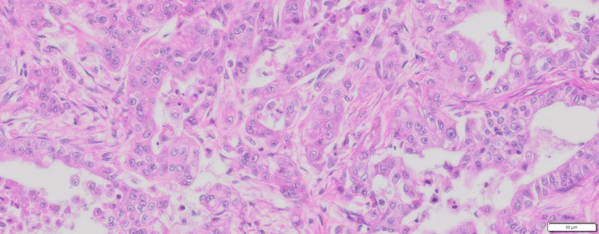 Human Pancreas Cancer (Ampullary Adenocarcinoma) FFPE Sections