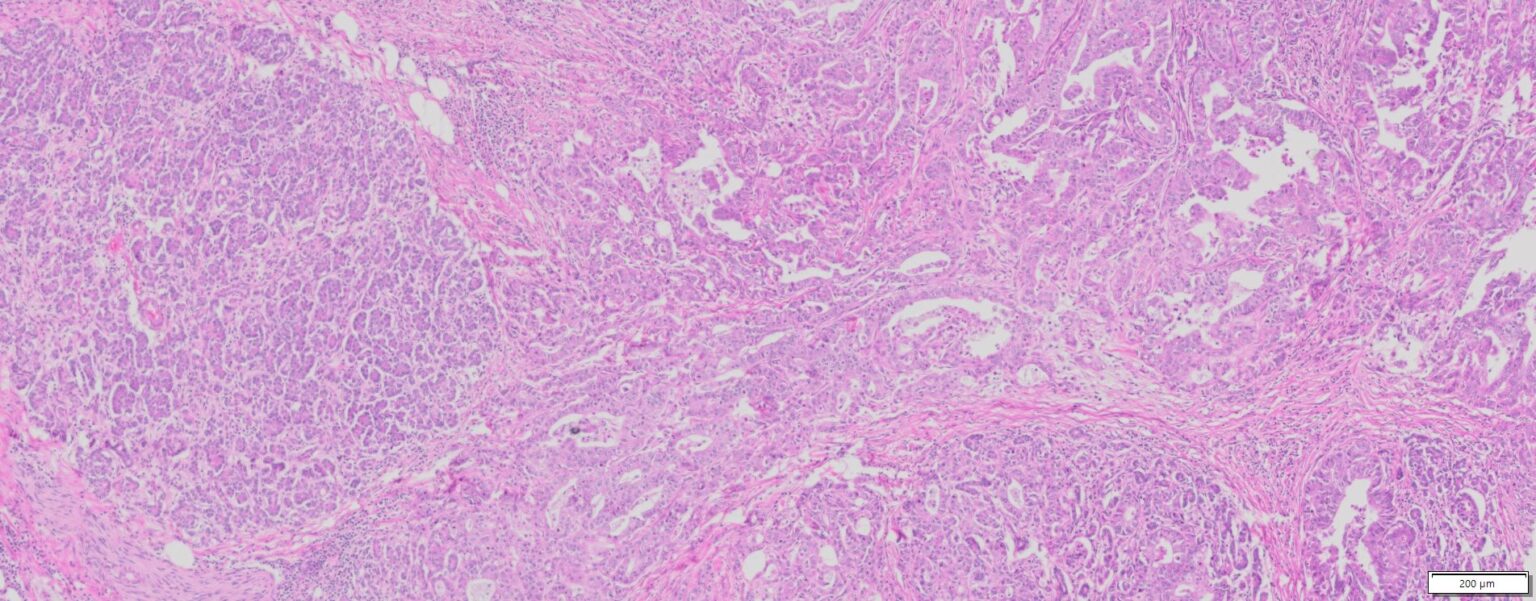 Human Pancreas Cancer (Ampullary Adenocarcinoma) FFPE Sections