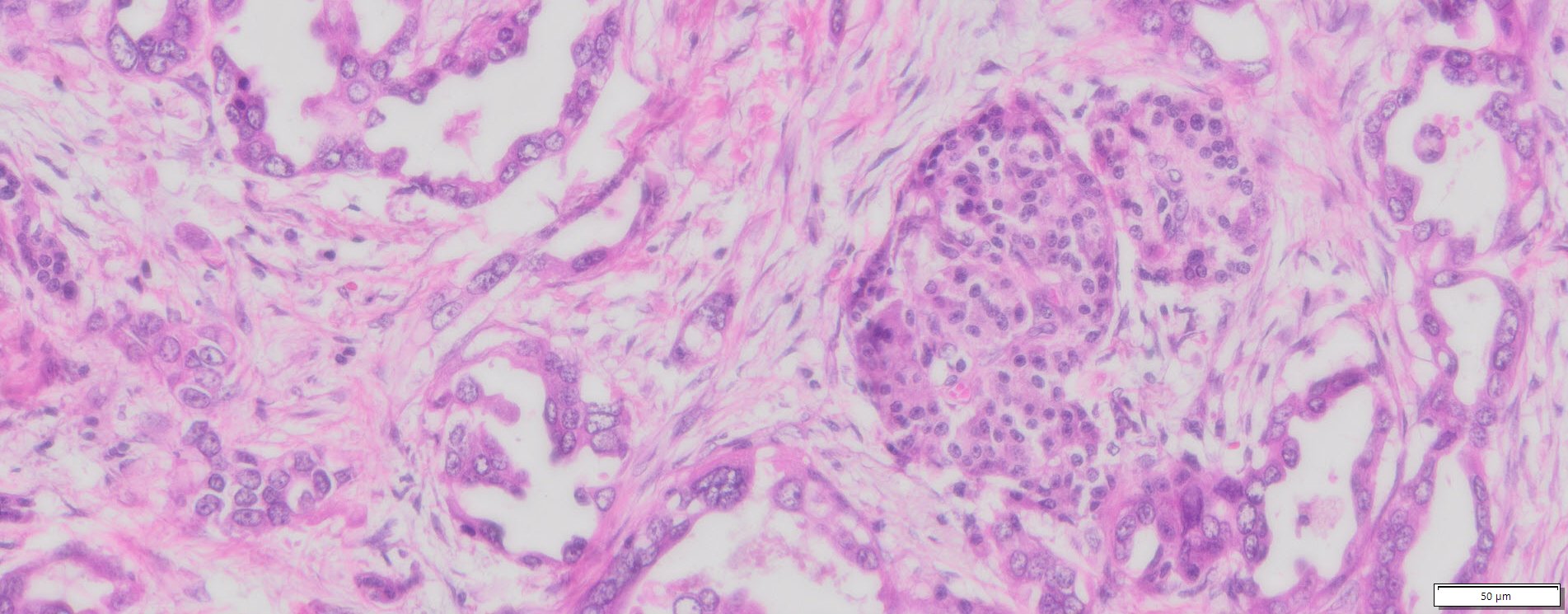 Human Pancreas Cancer (Adenocarcinoma and Neuroendocrine Tumor) FFPE ...