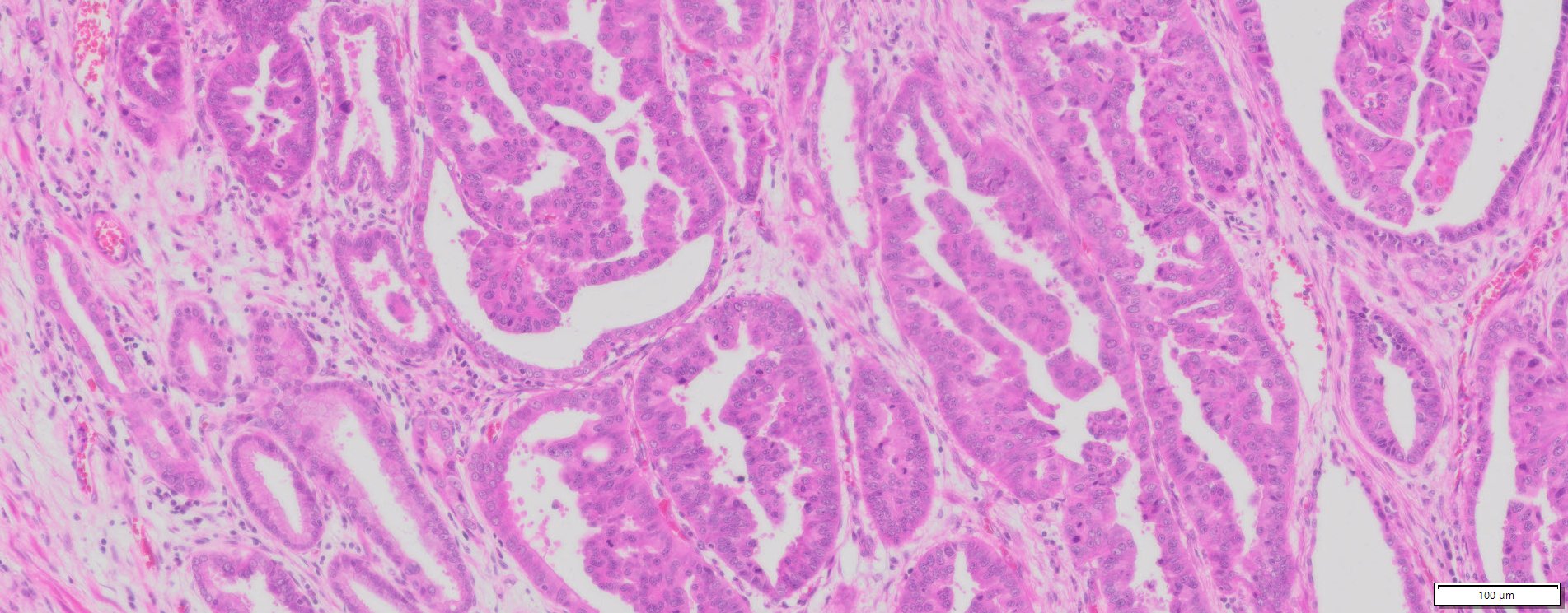 Human Pancreas Cancer (Adenocarcinoma) FFPE Sections