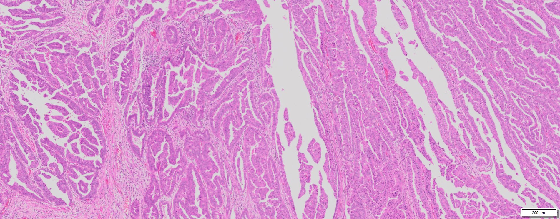 Human Pancreas Cancer (Adenocarcinoma) FFPE Sections