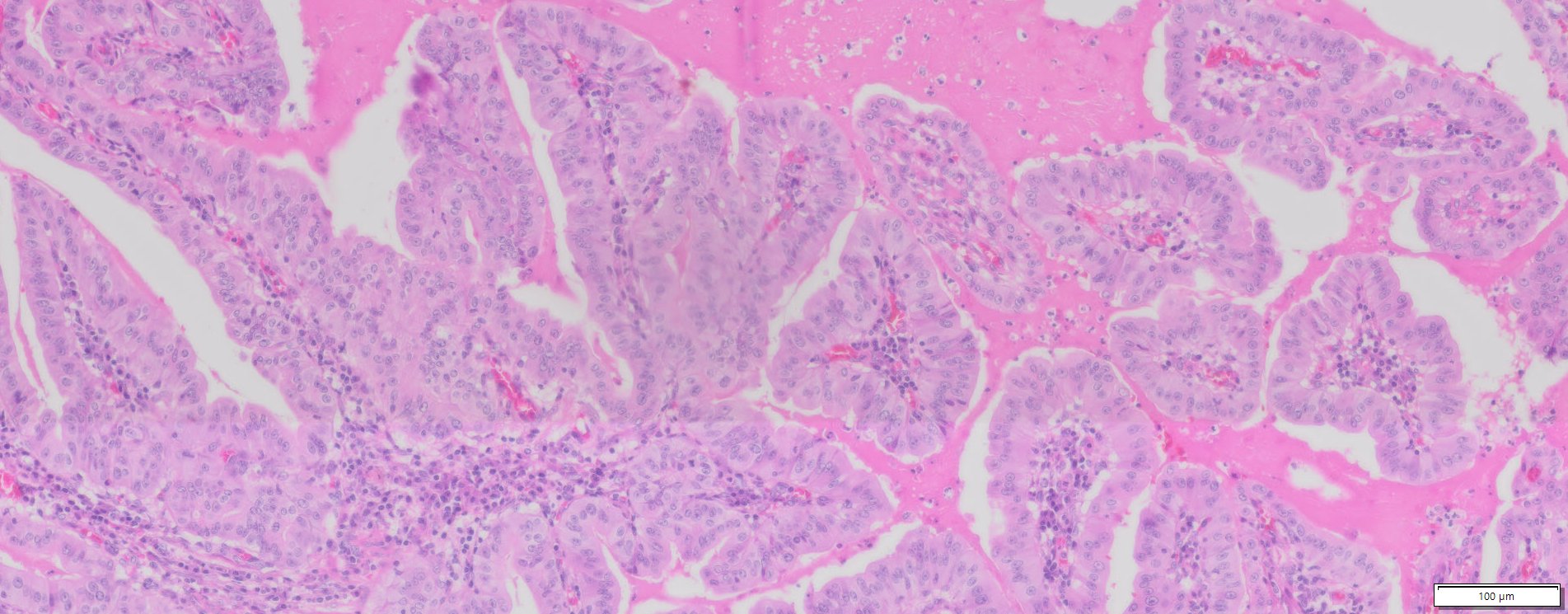 Human Pancreas Cancer (Adenocarcinoma) FFPE Sections