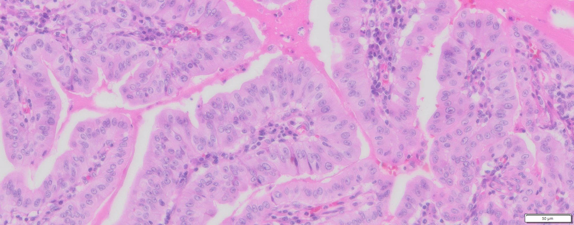 Human Pancreas Cancer (Adenocarcinoma) FFPE Sections