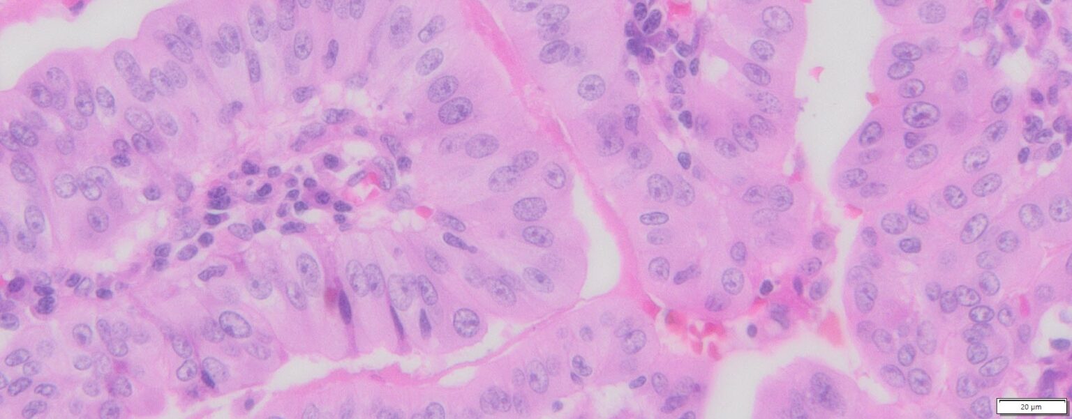 Human Pancreas Cancer (Adenocarcinoma) FFPE Sections