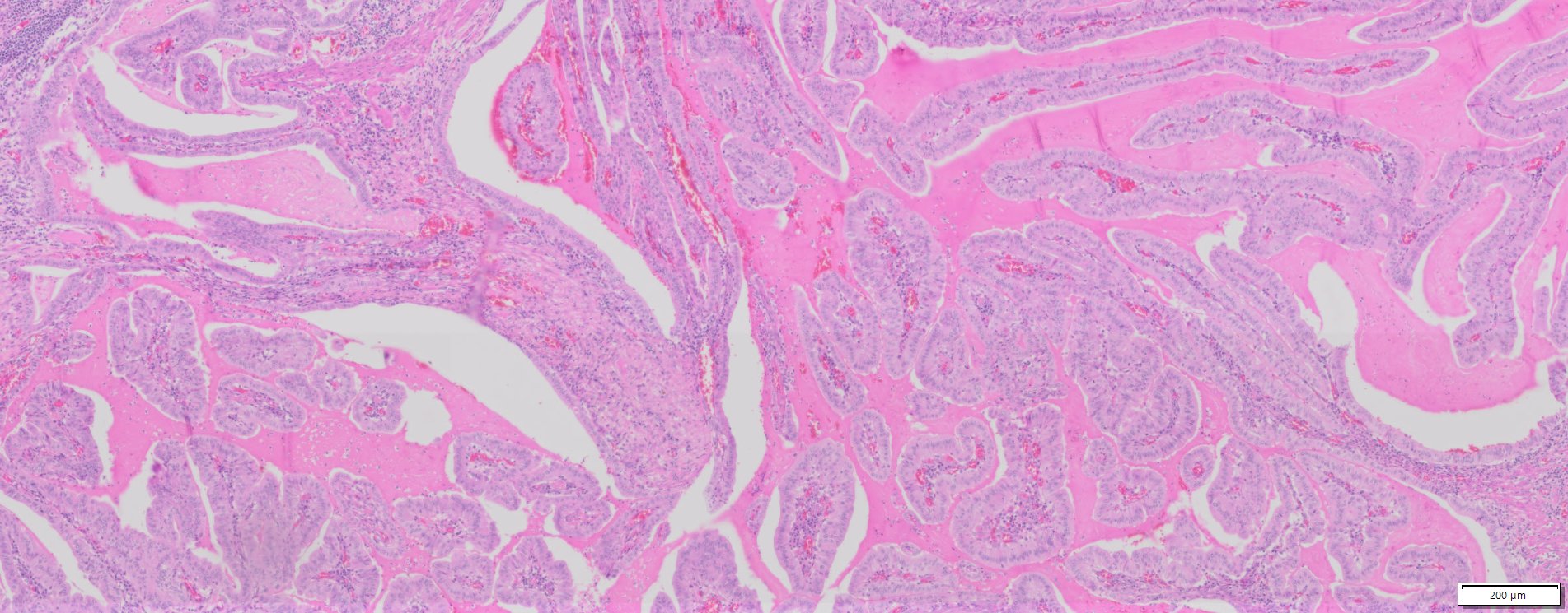Human Pancreas Cancer (Adenocarcinoma) FFPE Sections