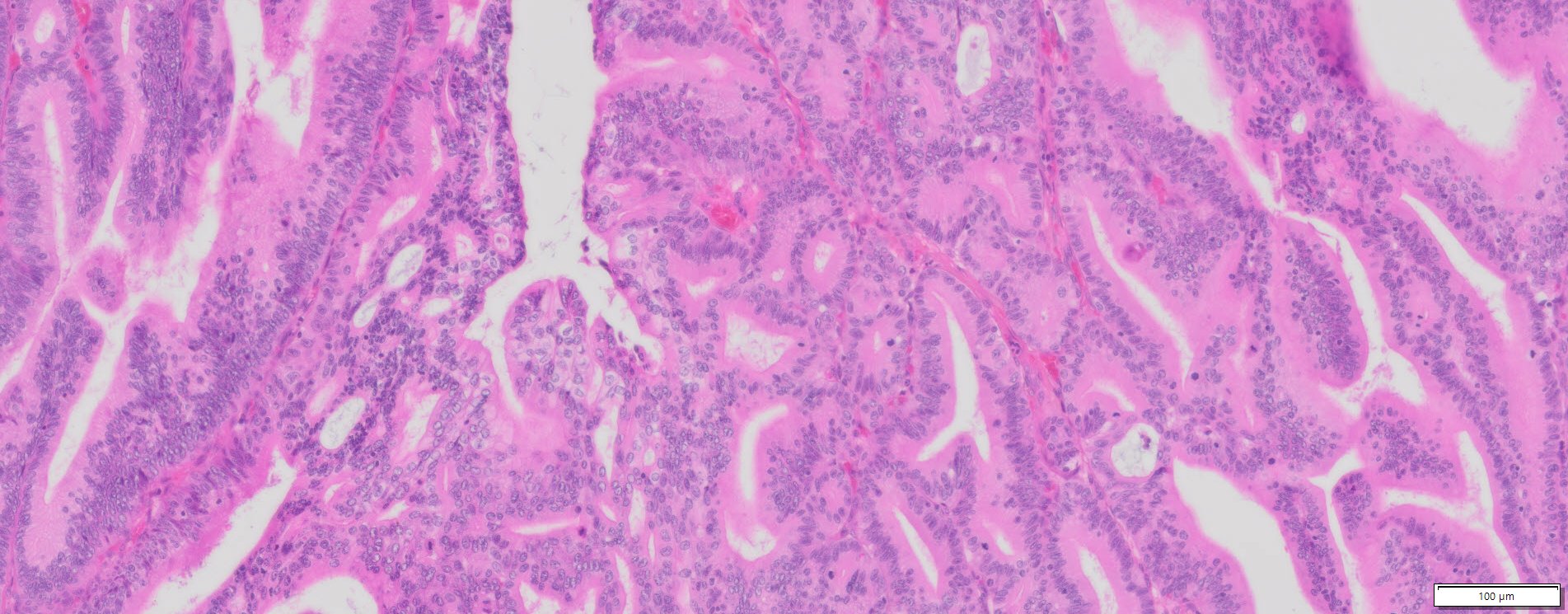 Human Pancreas Cancer (Adenocarcinoma) FFPE Sections