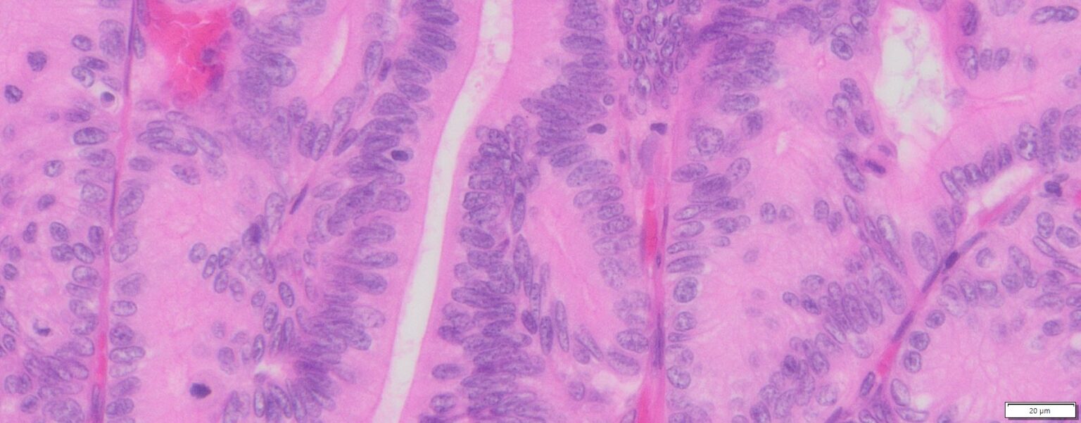 Human Pancreas Cancer (Adenocarcinoma) FFPE Sections