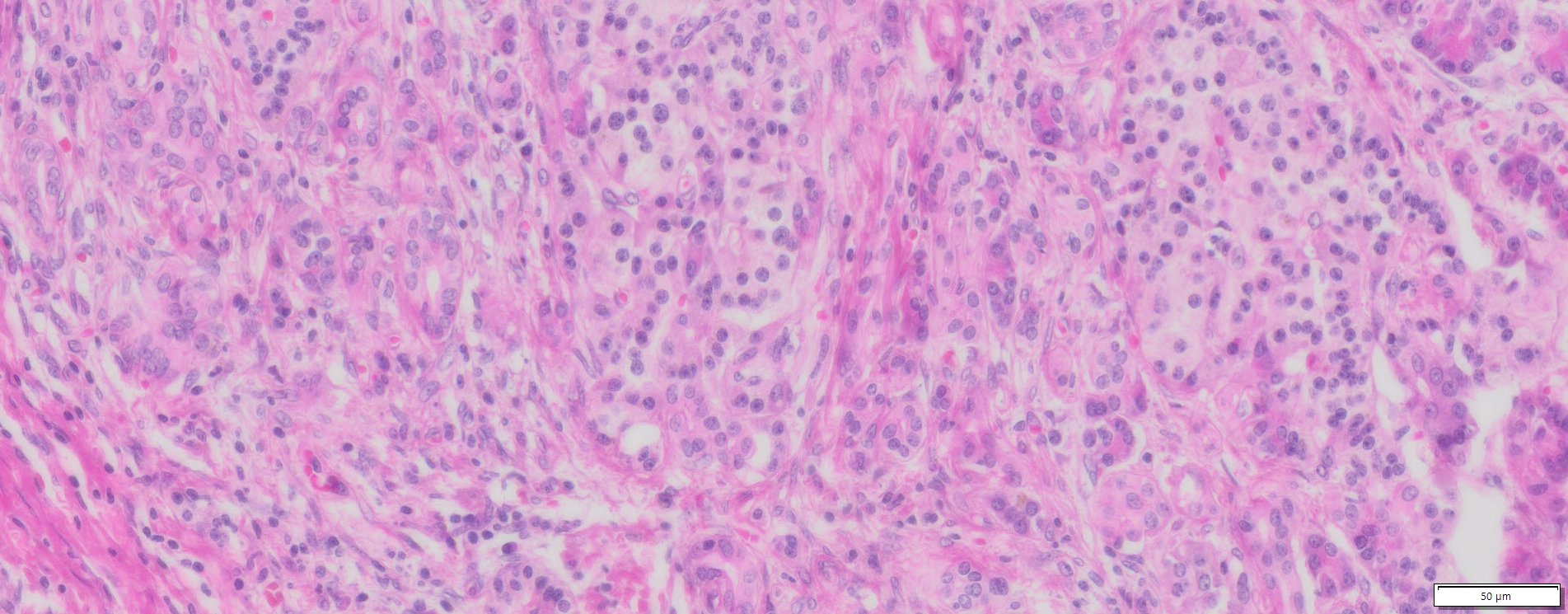 Human Pancreas Cancer (Neuroendocrine Tumor) FFPE Sections