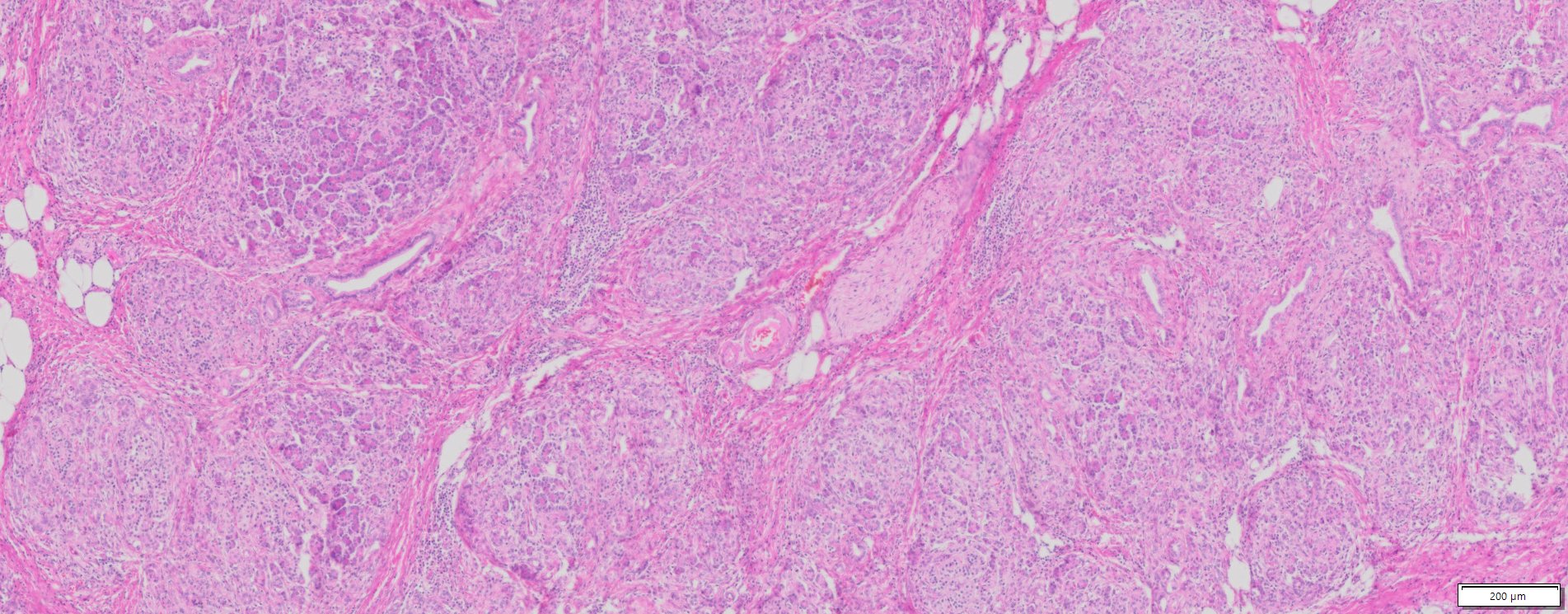 Human Pancreas Cancer (Neuroendocrine Tumor) FFPE Sections