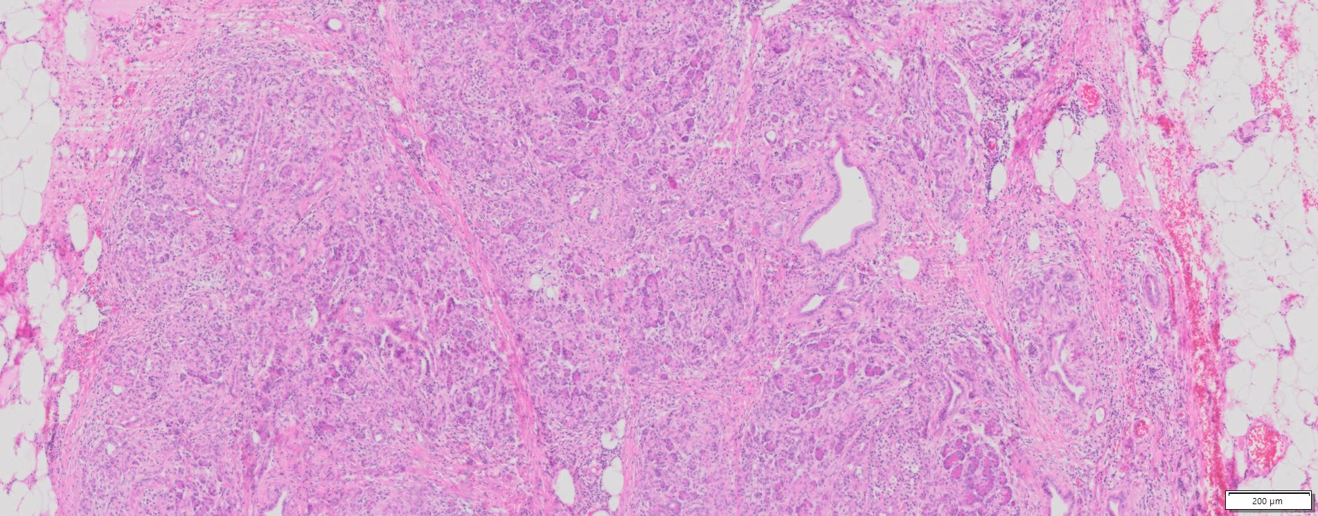 Human Pancreas Cancer (Neuroendocrine Tumor) FFPE Sections