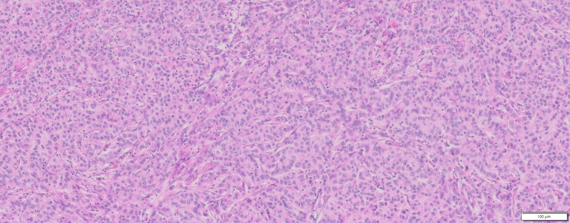 Human Pancreas Cancer (Adenocarcinoma and Neuroendocrine Tumor) FFPE ...