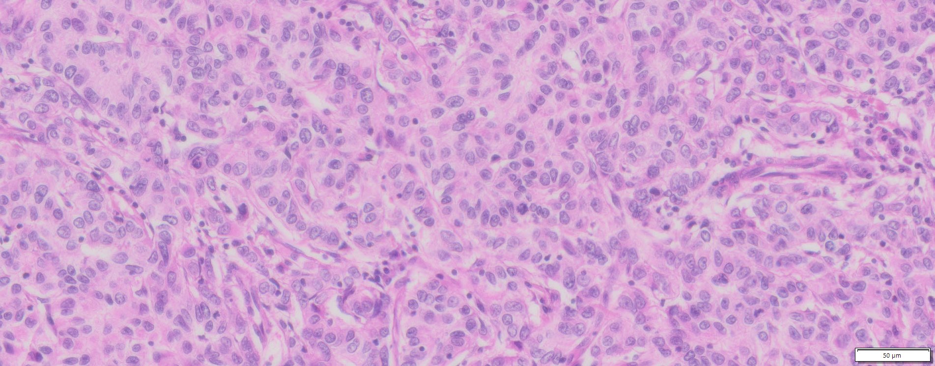 Human Pancreas Cancer (Adenocarcinoma and Neuroendocrine Tumor) FFPE ...