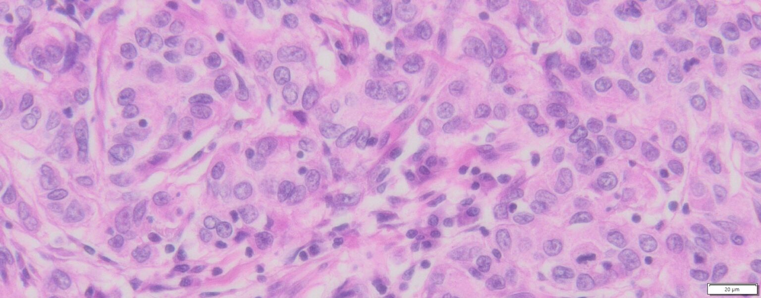 Human Pancreas Cancer (Adenocarcinoma and Neuroendocrine Tumor) FFPE ...