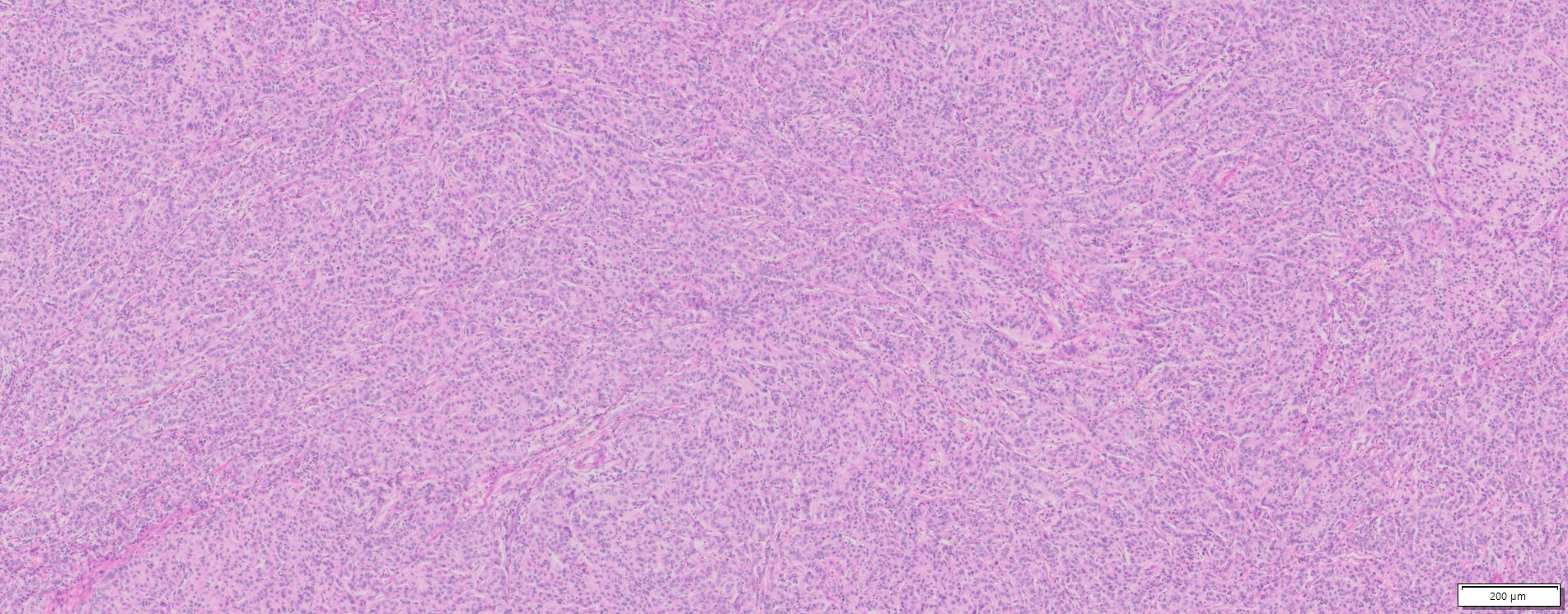 Human Pancreas Cancer (Adenocarcinoma and Neuroendocrine Tumor) FFPE ...