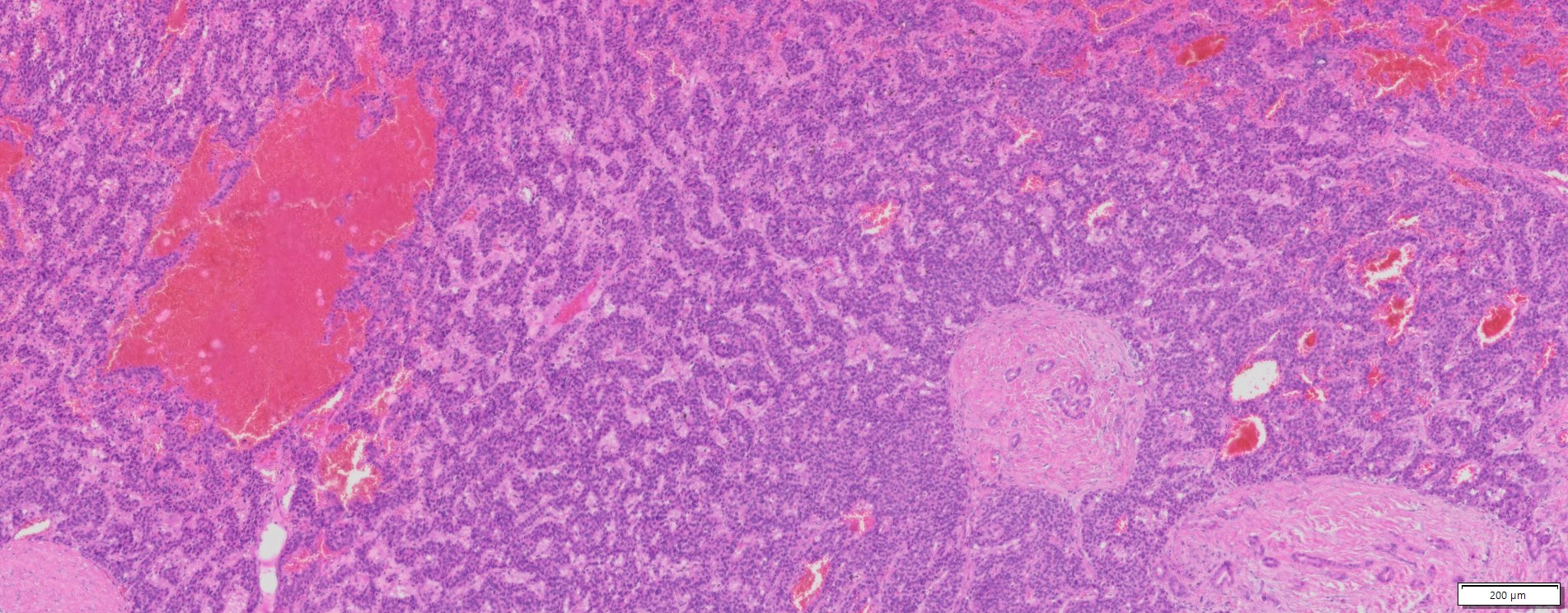 Human Pancreas Cancer (Neuroendocrine Tumor) FFPE Sections
