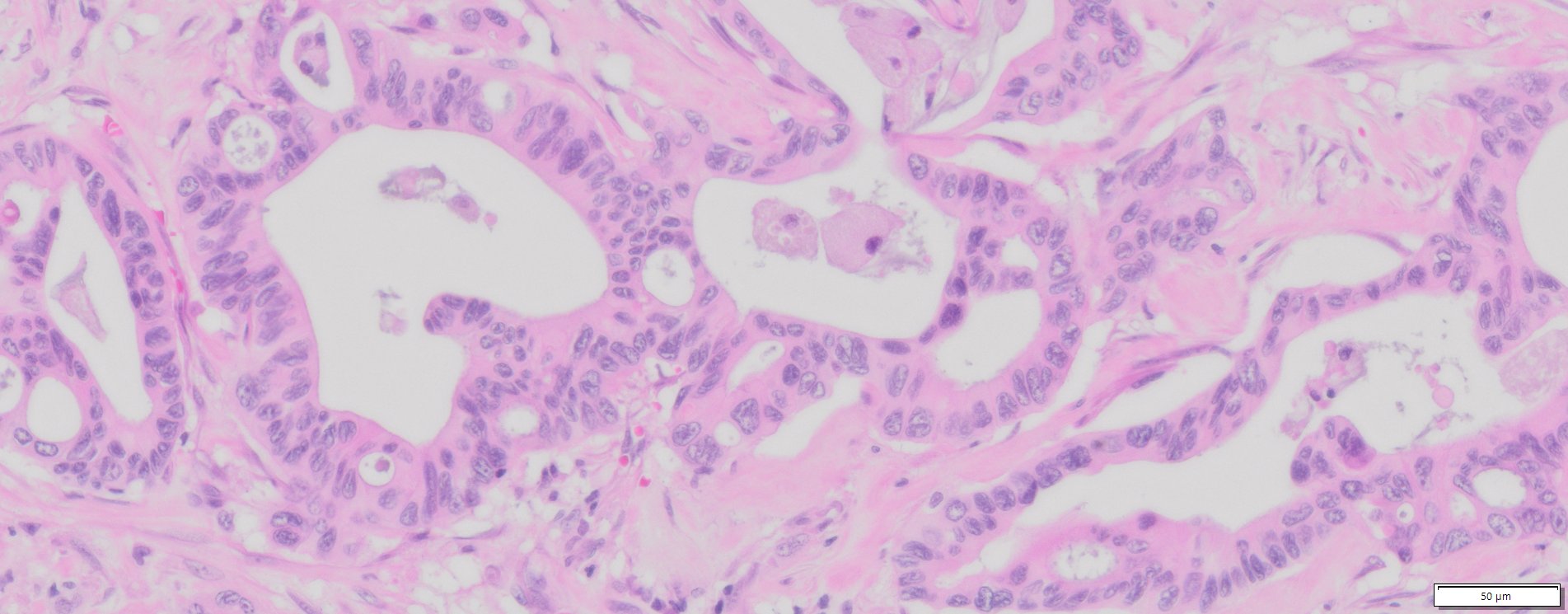 Human Pancreas Cancer (Adenocarcinoma) FFPE Sections
