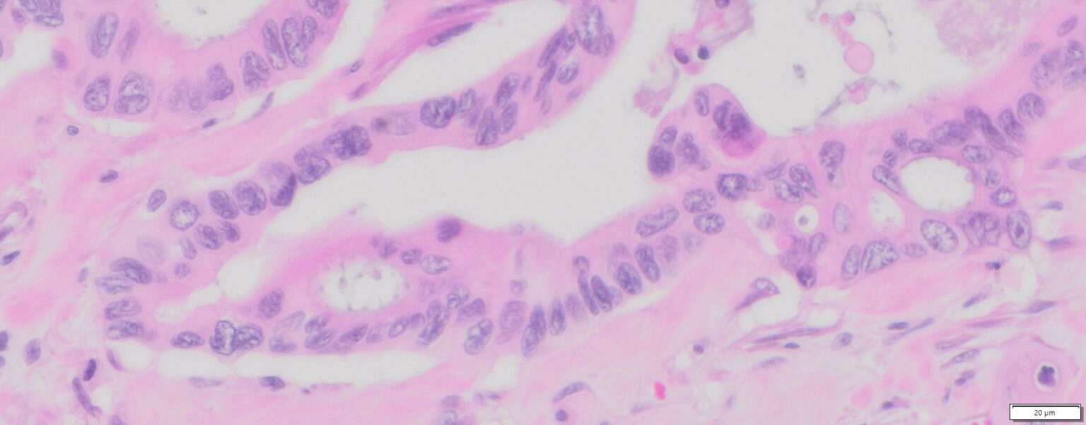 Human Pancreas Cancer (Adenocarcinoma) FFPE Sections