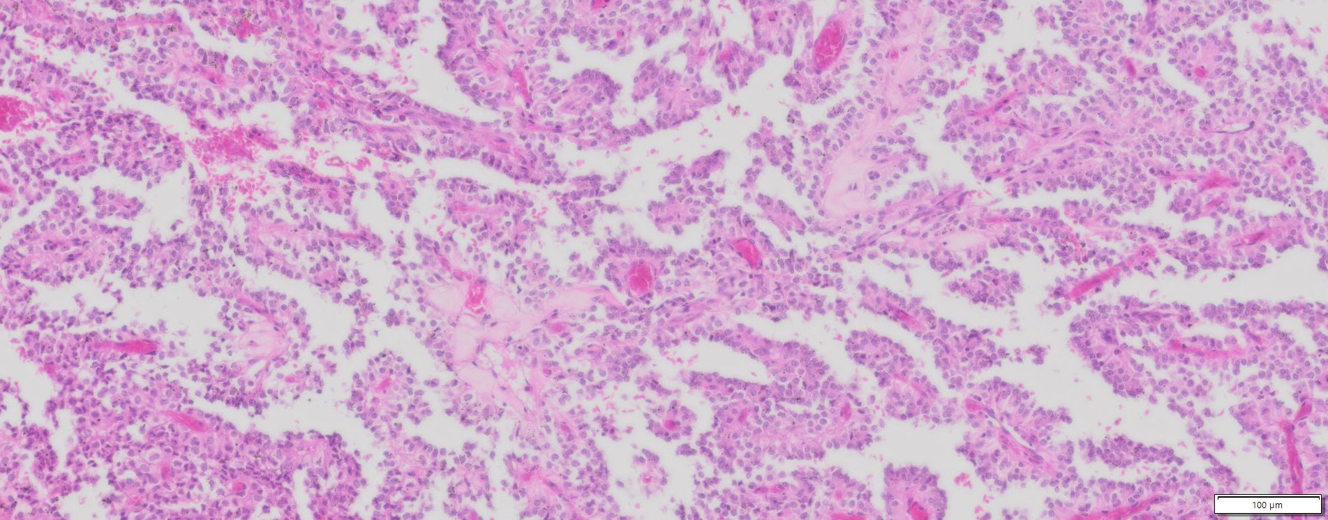 Human Pancreas Cancer (Neuroendocrine Tumor) FFPE Sections