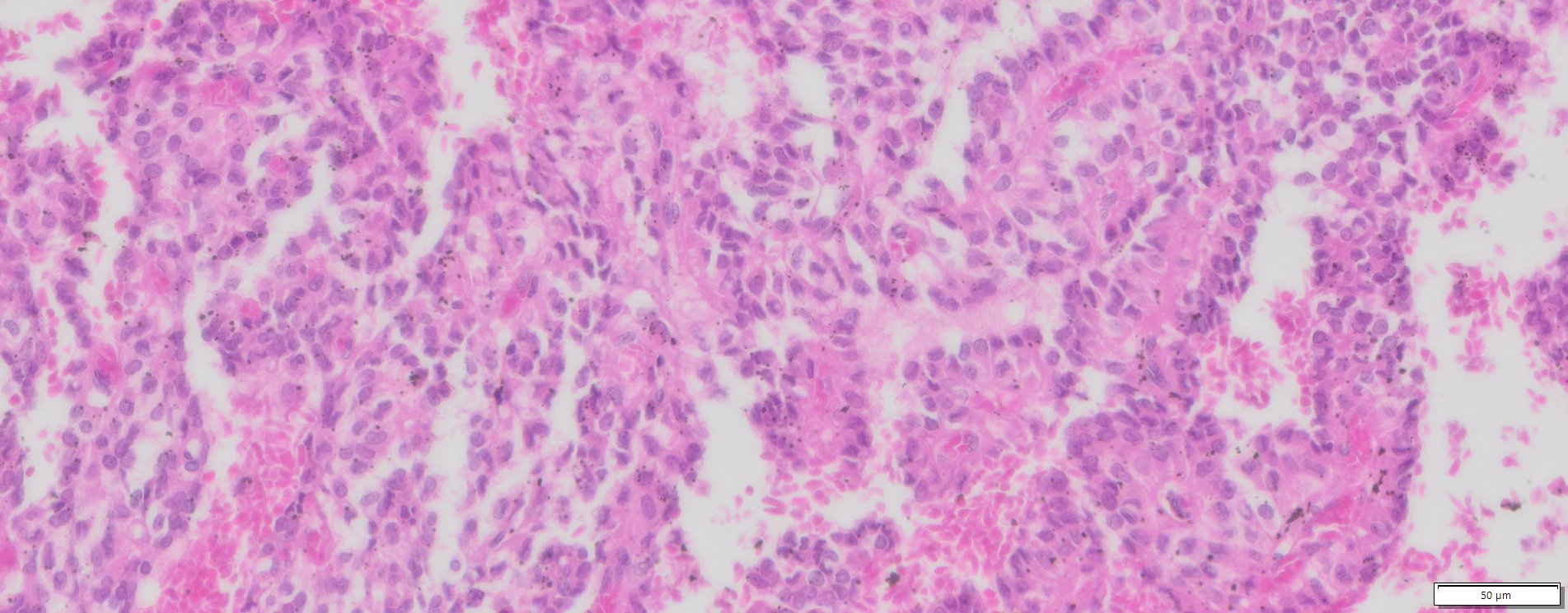 Human Pancreas Cancer (Neuroendocrine Tumor) FFPE Sections